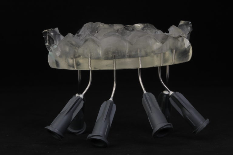 Case 2: Injectable Technique – Composite Veneers – Case Report with 6 ...