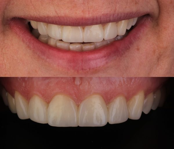 Case 2: Injectable Technique – Composite Veneers – Case Report with 6 ...