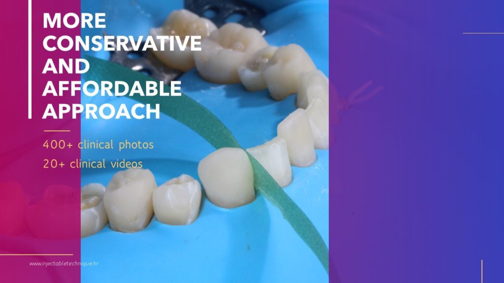 [2-in-1 Package] Composite Veneers Masterclass + Full Mouth ...