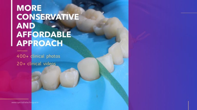 [ALL YOU CAN WATCH] Composite Veneers Masterclass + Full Mouth ...