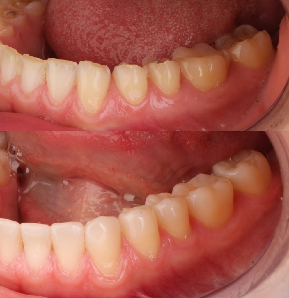 [ALL YOU CAN WATCH] Composite Veneers Masterclass + Full Mouth ...